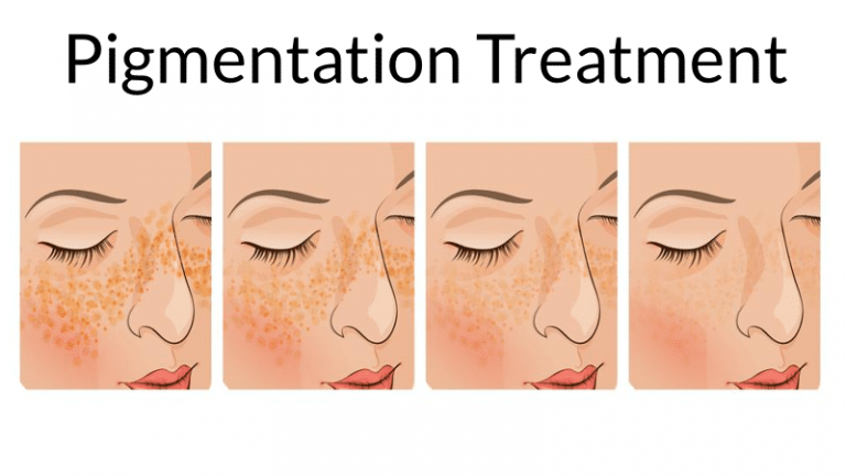 Laser Pigmentation Treatment - Sliq Clinic