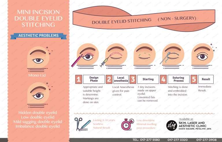 Double Eyelid Stitching Malaysia | Permanent & Natural Results