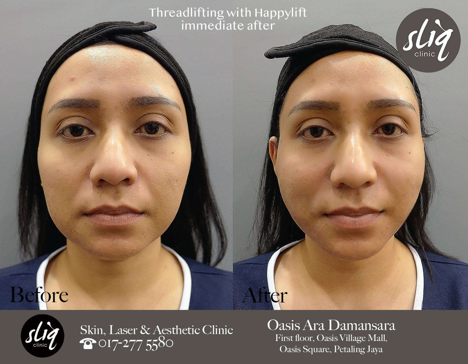 Thread Lift - Sliq Clinic